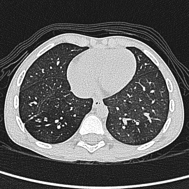 Interstitiella lungsjukdomar – idiopatiska pneumonier (IIP ...
