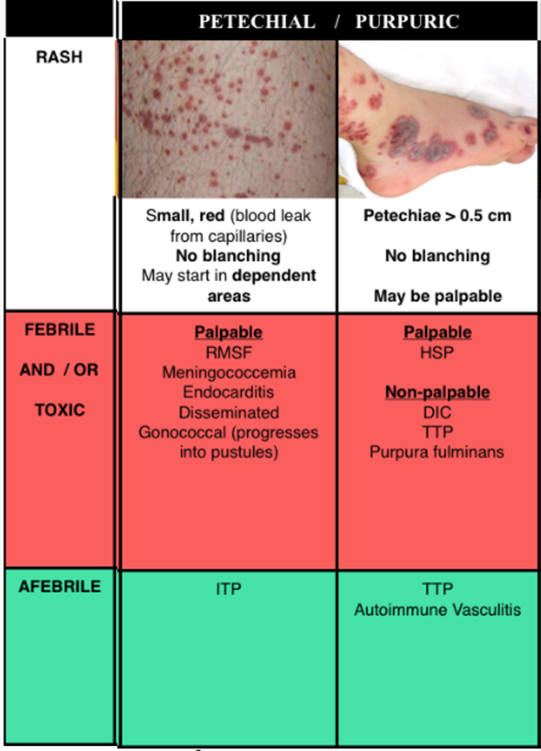 Trombocytopeni: ITP, TTP och HIT – diagnos och behandling - Narkosguiden