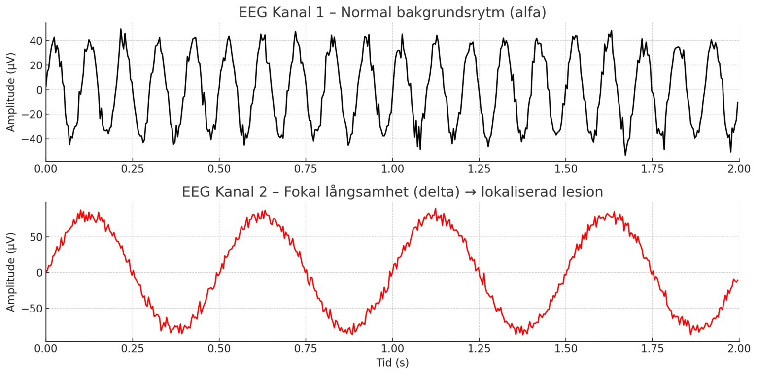 EEG – Elektroencefalografi: Indikationer, tolkning och klinisk ...